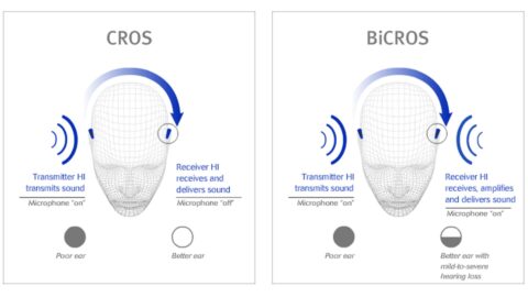 Audífonos CROS - BICROS: solución cuando solo oyes por un lado AUDIOALBA